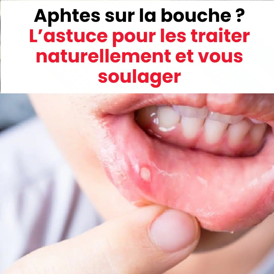 Aphtes : les meilleurs remèdes naturels pour les soulager – Psicologiaplus